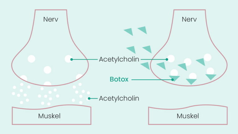 Kosmagic – Muskelrelaxans-Faltenbehandlung